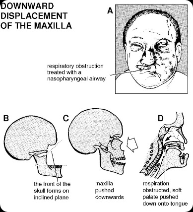 Cirurgia e Traumatologia BucoMaxiloFacial: Maxillofacial injuries